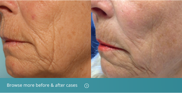 Fractionated Erbium Laser Treatment Beverly Hills, CA - Moy, Fincher ...