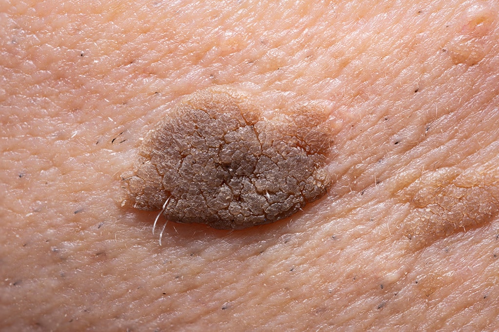 Seborrheic Keratosis Face Causes
