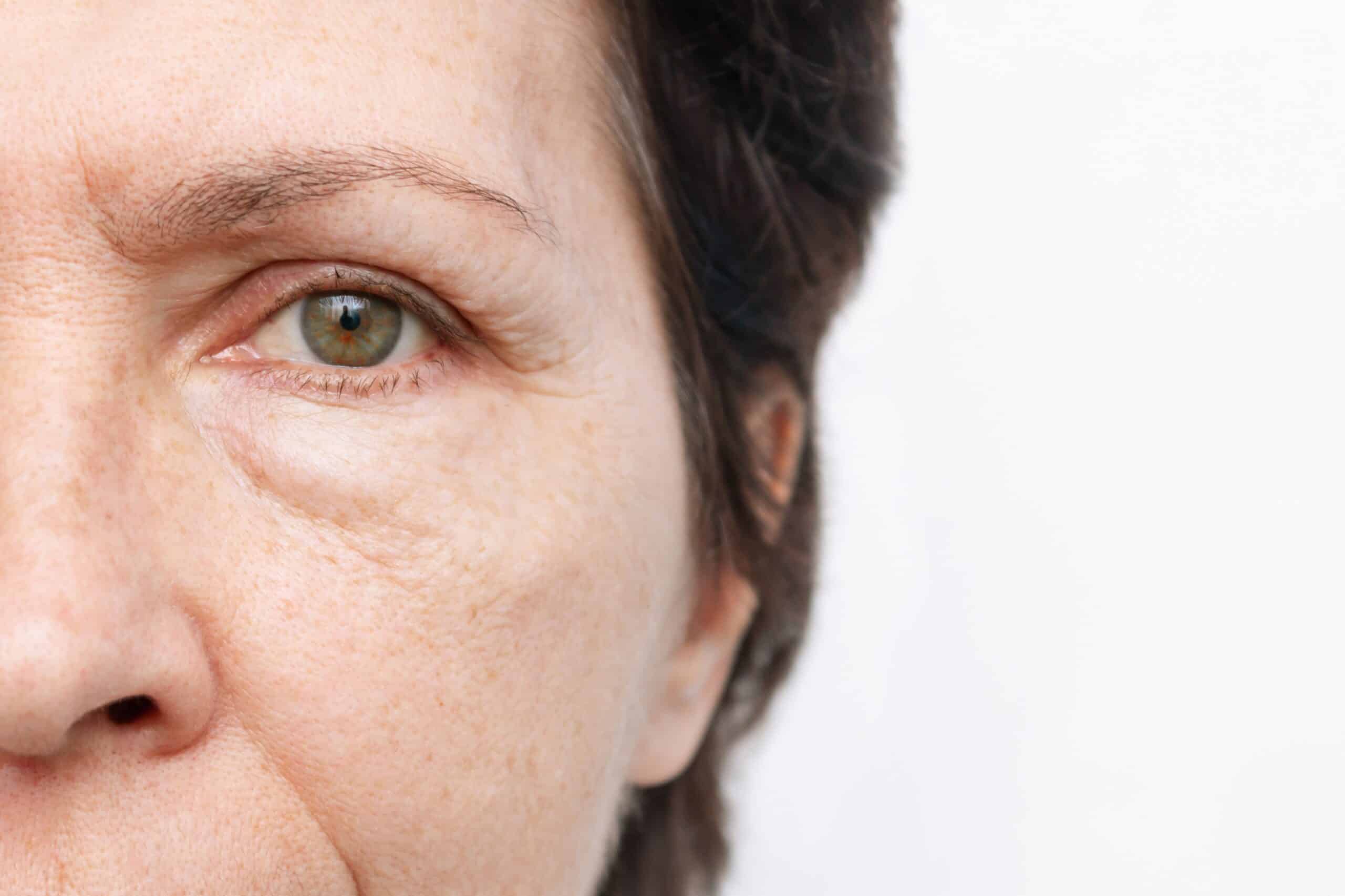 Say Goodbye to Under Eye Bags With Lower Eyelid Surgery | Moy Fincher ...