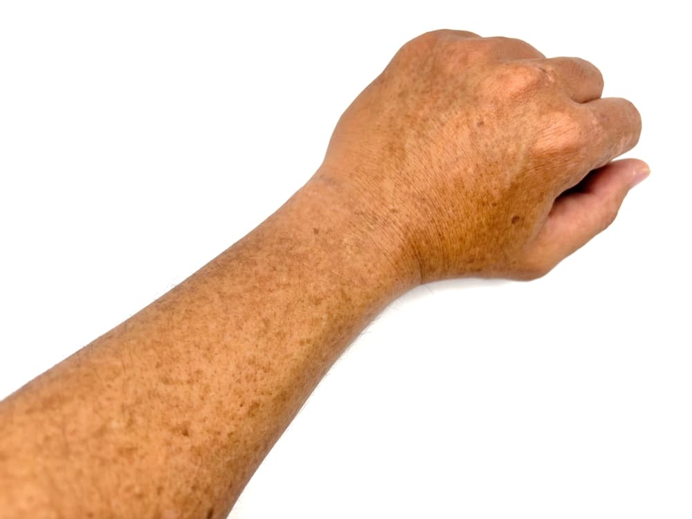 Transform Your Sun Damage Using Advanced Laser Technology | Moy Fincher ...